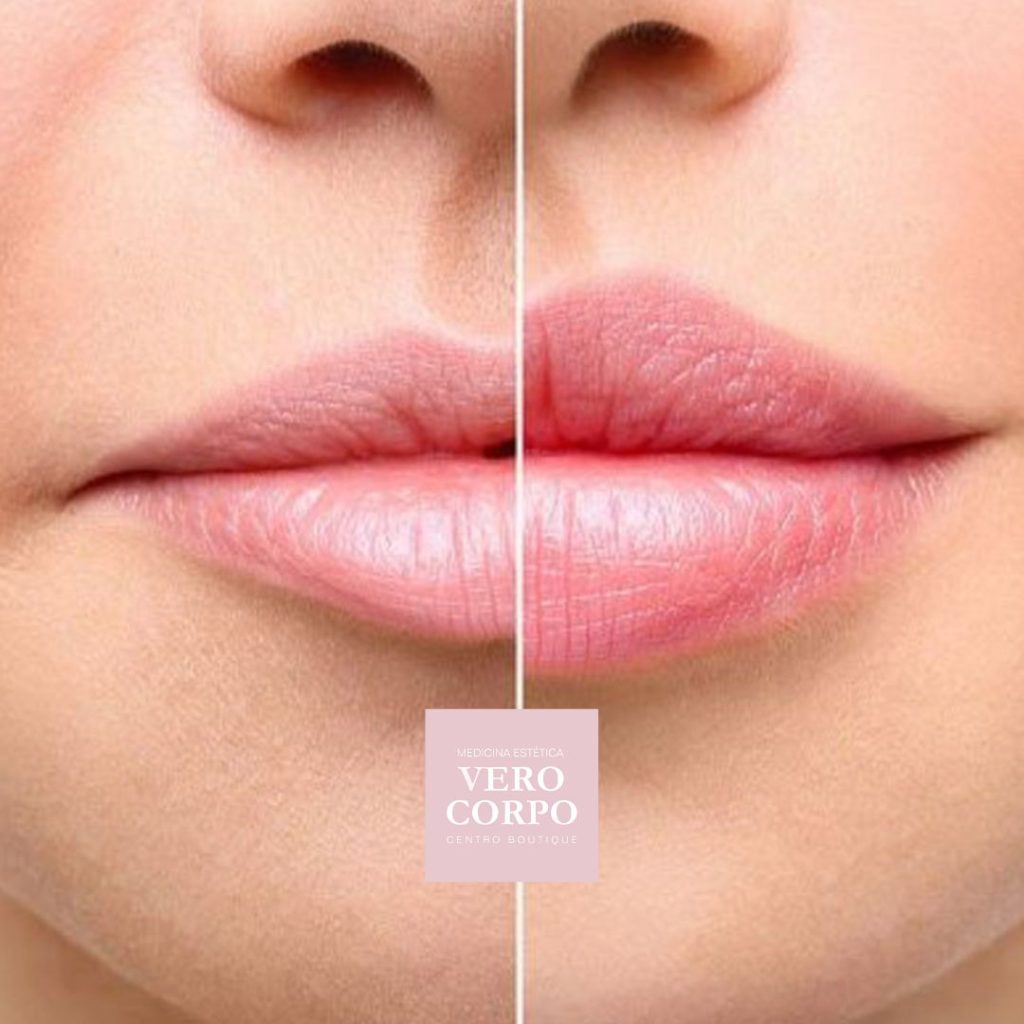 Relleno de labios – Vero Corpo